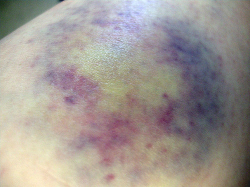 Why Do Bruises Turn Yellow? | New Health Advisor